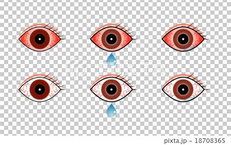 Congested eyes - Stock Illustration [18708365] - PIXTA