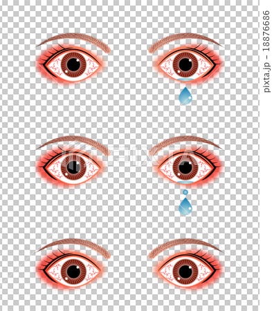 Congested eyes - Stock Illustration [18876686] - PIXTA