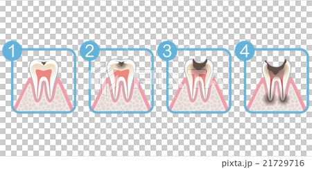 Caries progression - Stock Illustration [21729716] - PIXTA