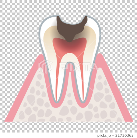 Caries progression - Stock Illustration [21730362] - PIXTA