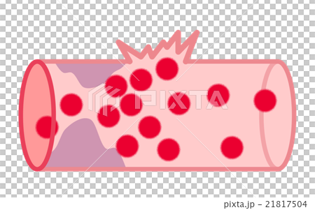 血管-插圖素材 [21817504] - PIXTA圖庫