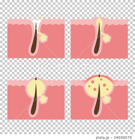 Excess secretion of sebum → clogging →... - Stock Illustration ...