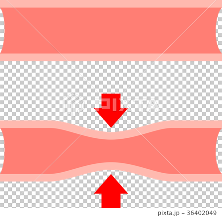 Normal blood vessels and compressed blood vessels - Stock Illustration ...