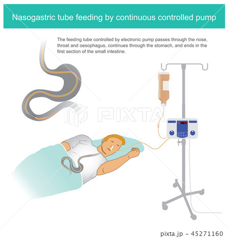 Nasogastric tube feedingのイラスト素材 [45271160] - PIXTA