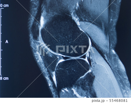 Knee injury mri mcl tearの写真素材 [55468081] - PIXTA