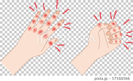 Chapped - Stock Illustration [57588566] - PIXTA