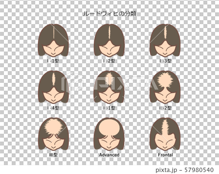 Classification of female androgenetic alopecia... - Stock Illustration ...