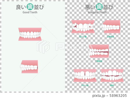 Illustration of good and bad teeth - Stock Illustration [58963205] - PIXTA