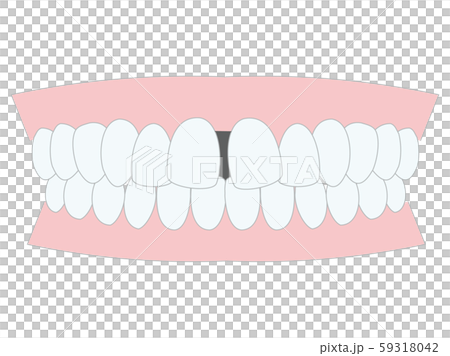 Malocclusion, midline separation, tooth alignment - Stock Illustration ...