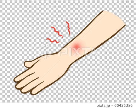 Arm bites - Stock Illustration [60425386] - PIXTA