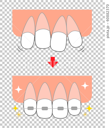 Straighten rattle teeth alignment front teeth - Stock Illustration ...