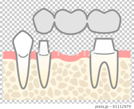 Bridge silver tooth illustration abutment... - Stock Illustration ...