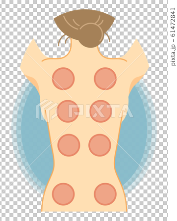 Cupping treatment mark (back) - Stock Illustration [61472841] - PIXTA