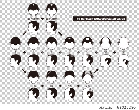 Hamilton Norwood Classification Bald - Stock Illustration [62029280 ...