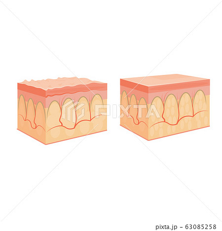 wrinkle and normal skin cross-section of human...のイラスト素材 [63085258] - PIXTA