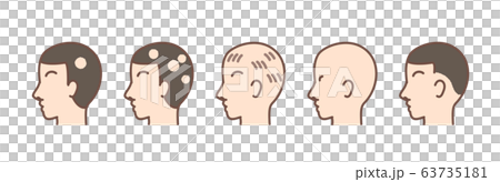 Alopecia areata Classification Profile A... - Stock Illustration ...