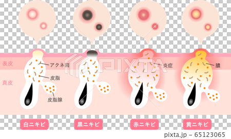 Acne Symptoms Skin Cross Section - Stock Illustration [65123065] - PIXTA