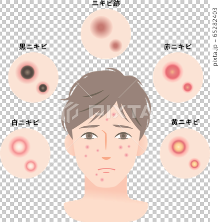 Types of acne male - Stock Illustration [65282403] - PIXTA