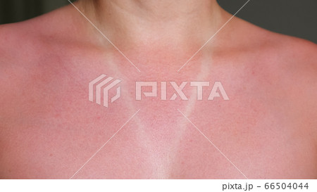 young woman bare sunburned red chest and neck...の写真素材 [66504044] - PIXTA