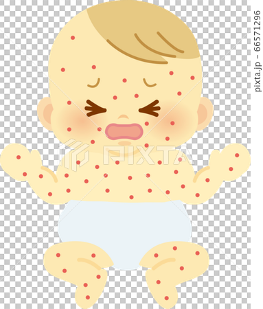 Baby in a diaper with a rash on her whole body... - Stock Illustration ...