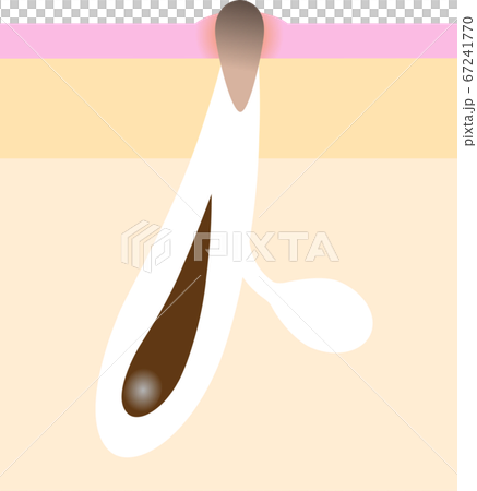 Blackhead pore cross section - Stock Illustration [67241770] - PIXTA
