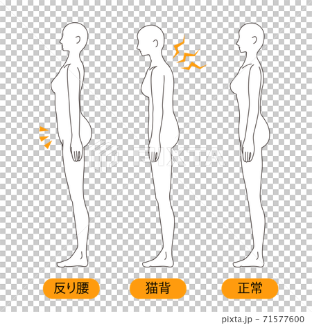 Female medical posture (warped waist, stoop)... - Stock Illustration ...