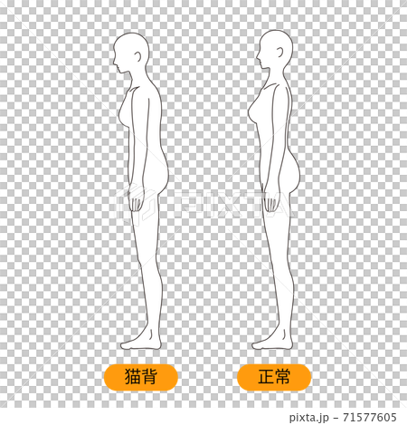 Female medical posture (stoop) beauty naked... - Stock Illustration ...