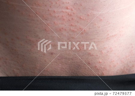 Groin Rash In Men
