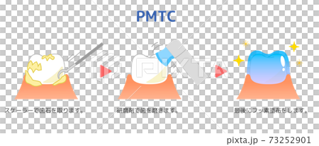 PMTC Teeth Cleaning: Dental Illustration - Stock Illustration [73252901 ...
