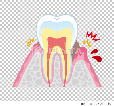 Alveolar pyorrhea illustration - Stock Illustration [74010010] - PIXTA