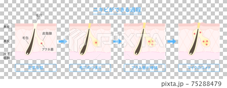 Illustration of the process of acne formation... - Stock Illustration ...