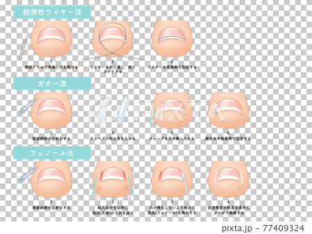 Ingrown nails, ingrown toenails, gutter method,... - Stock Illustration ...