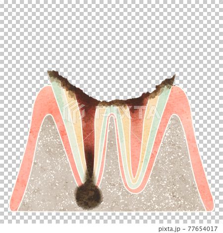 Cross section of cavities (C4) - Stock Illustration [77654017] - PIXTA