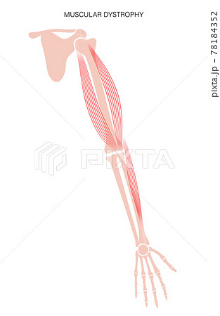 Muscular dystrophy of armのイラスト素材 [78184352] - PIXTA