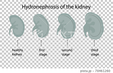 Renal hydronephrosis is a progressive,stages of... - Stock Illustration ...
