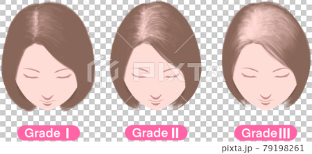 Female androgenetic alopecia, Ludwig... - Stock Illustration [79198261 ...