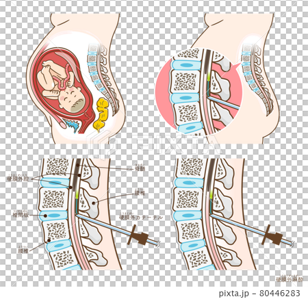 Illustration of painless delivery and epidural... - Stock Illustration ...