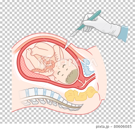 Caesarean section surgery and foetation - Stock Illustration [80606085 ...