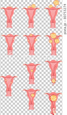 Uterine fibroid illustration - Stock Illustration [80753274] - PIXTA
