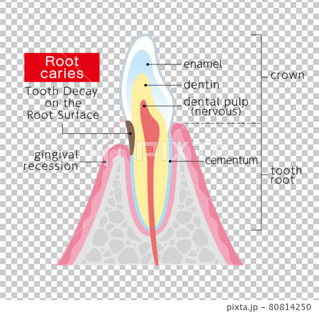 Root caries illustration illustration in English - Stock Illustration ...