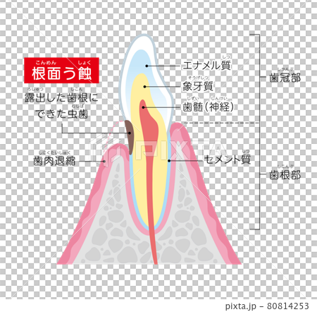 Root caries illustration illustration - Stock Illustration [80814253 ...