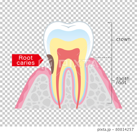 Root caries illustration illustration in English - Stock Illustration ...