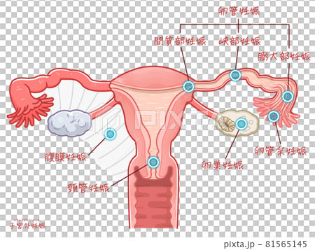 Illustration of ectopic pregnancy uterus,... - Stock Illustration ...