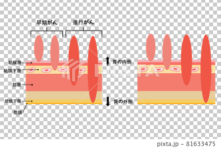 Illustrated illustrations of early and advanced... - Stock Illustration ...