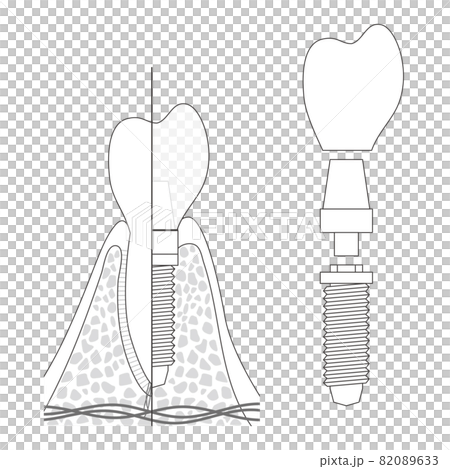 Structural illustration of implant - Stock Illustration [82089633] - PIXTA