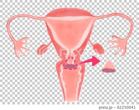 Watercolor illustration of cervical conization - Stock Illustration ...