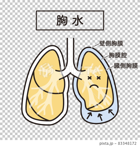 Simple illustration pleural effusion lung - Stock Illustration ...