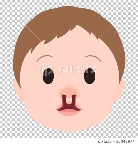 Illustration of bilateral cleft lip and palate... - Stock Illustration ...