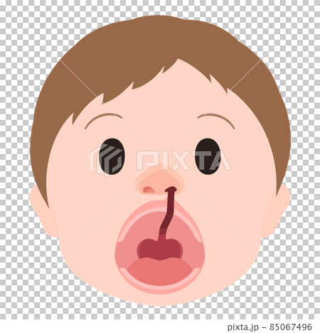 Illustration of cleft lip and palate _... - Stock Illustration ...