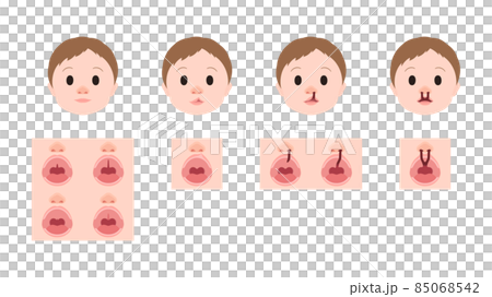 Cleft lip and palate_Illustration of the front... - Stock Illustration ...